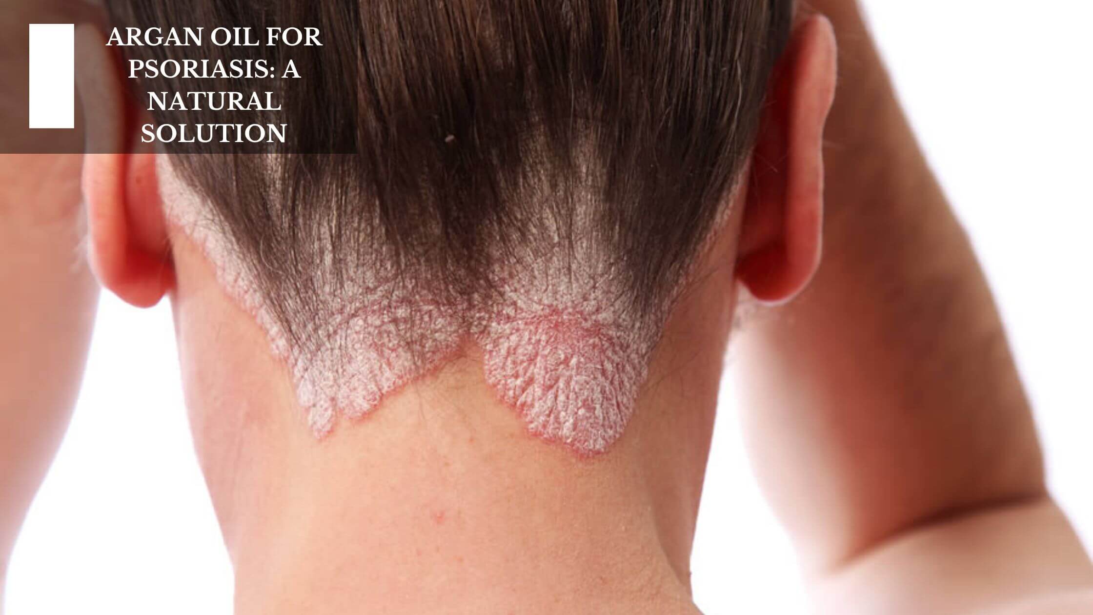 Argan Oil For Psoriasis: A Natural Solution – Moksha Lifestyle Products