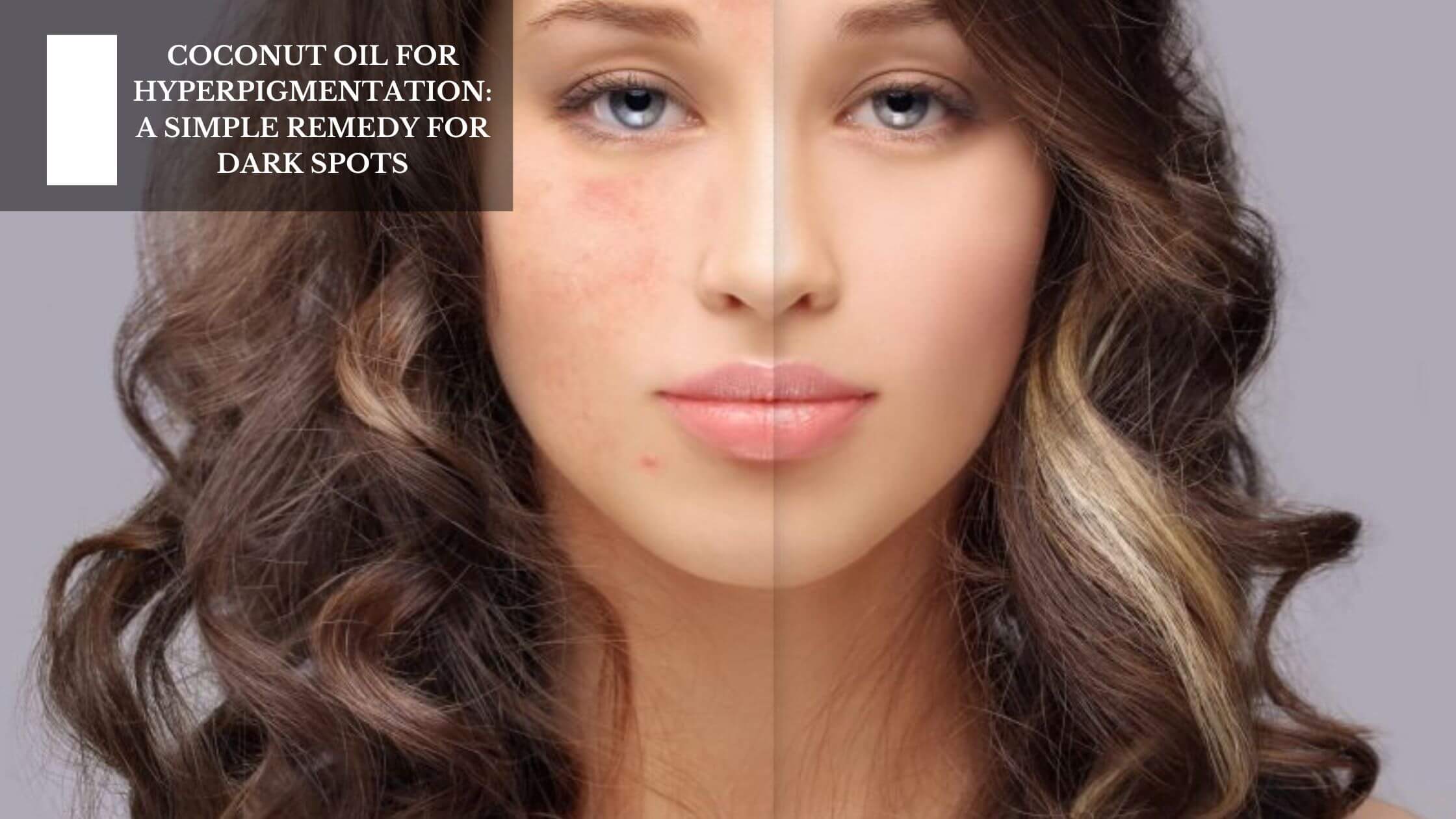Coconut Oil For Hyperpigmentation: A Simple Remedy For Dark Spots ...