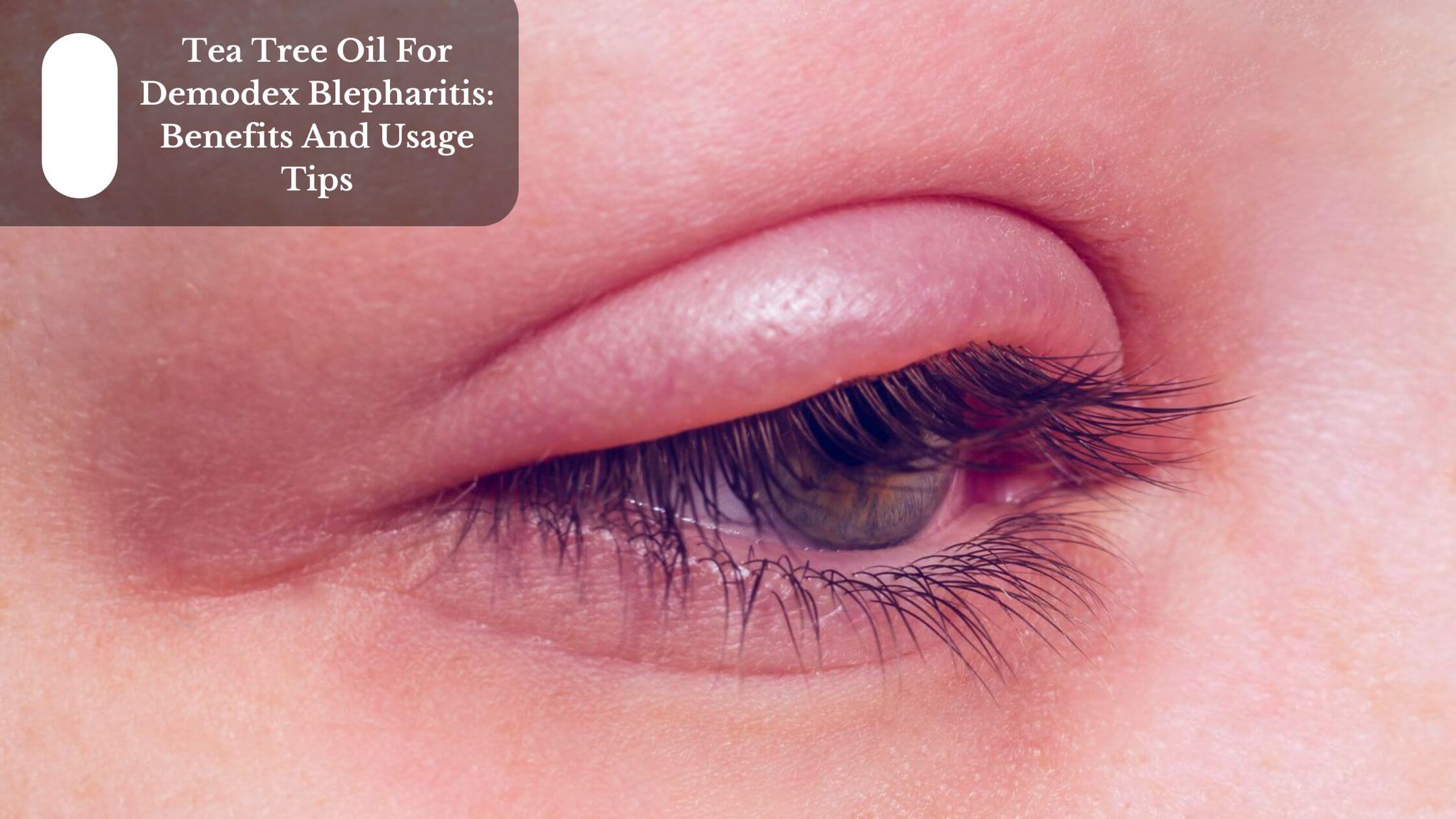 Tea Tree Oil For Demodex Blepharitis: Benefits And Usage Tips – Moksha ...